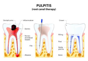 What is An Exposed Tooth Nerve? (Symptoms, Causes, and Treatment)